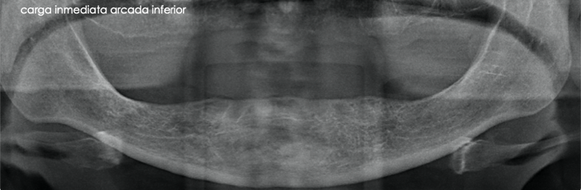 implantes arcadas