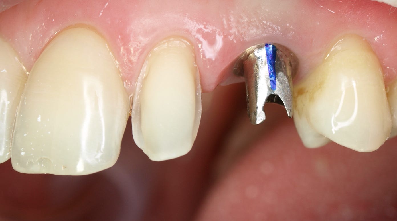 implantes dentales sector anterior